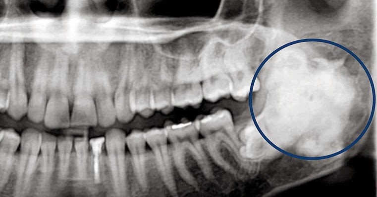 TUMORES en los Maxilares: Filosofía del tratamiento conservador ...