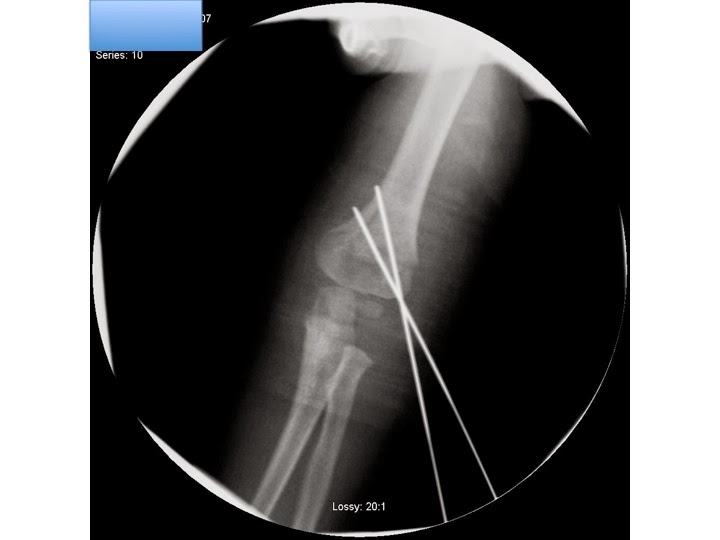 Shoulder and Elbow Surgery: Pediatric supracondylar humerus fracture.