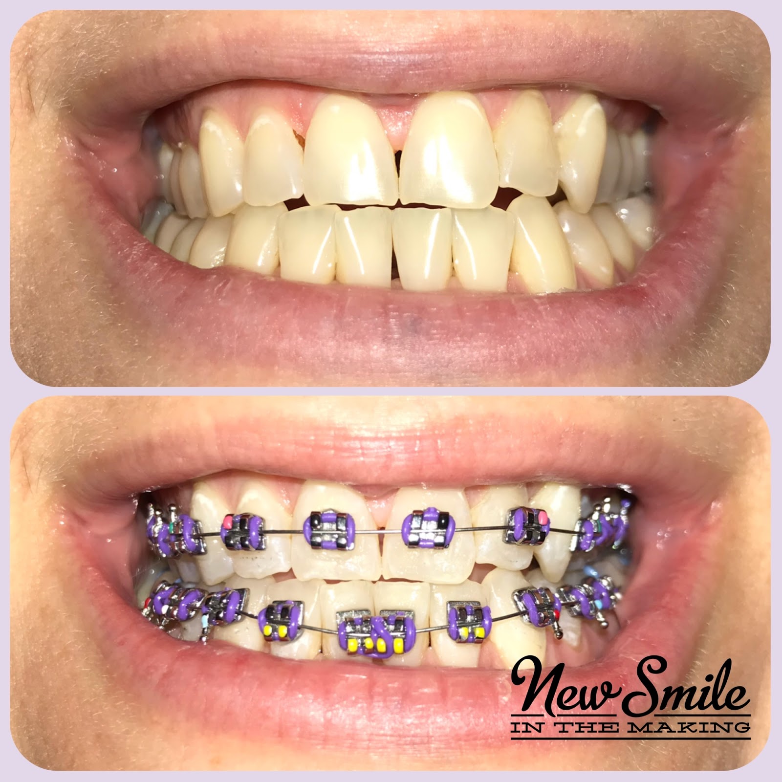 Dark Purple Braces