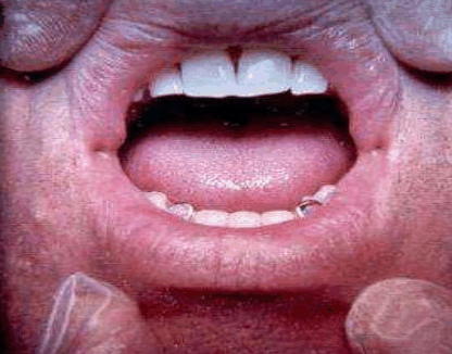 Oral Pathology Blog: May 2014