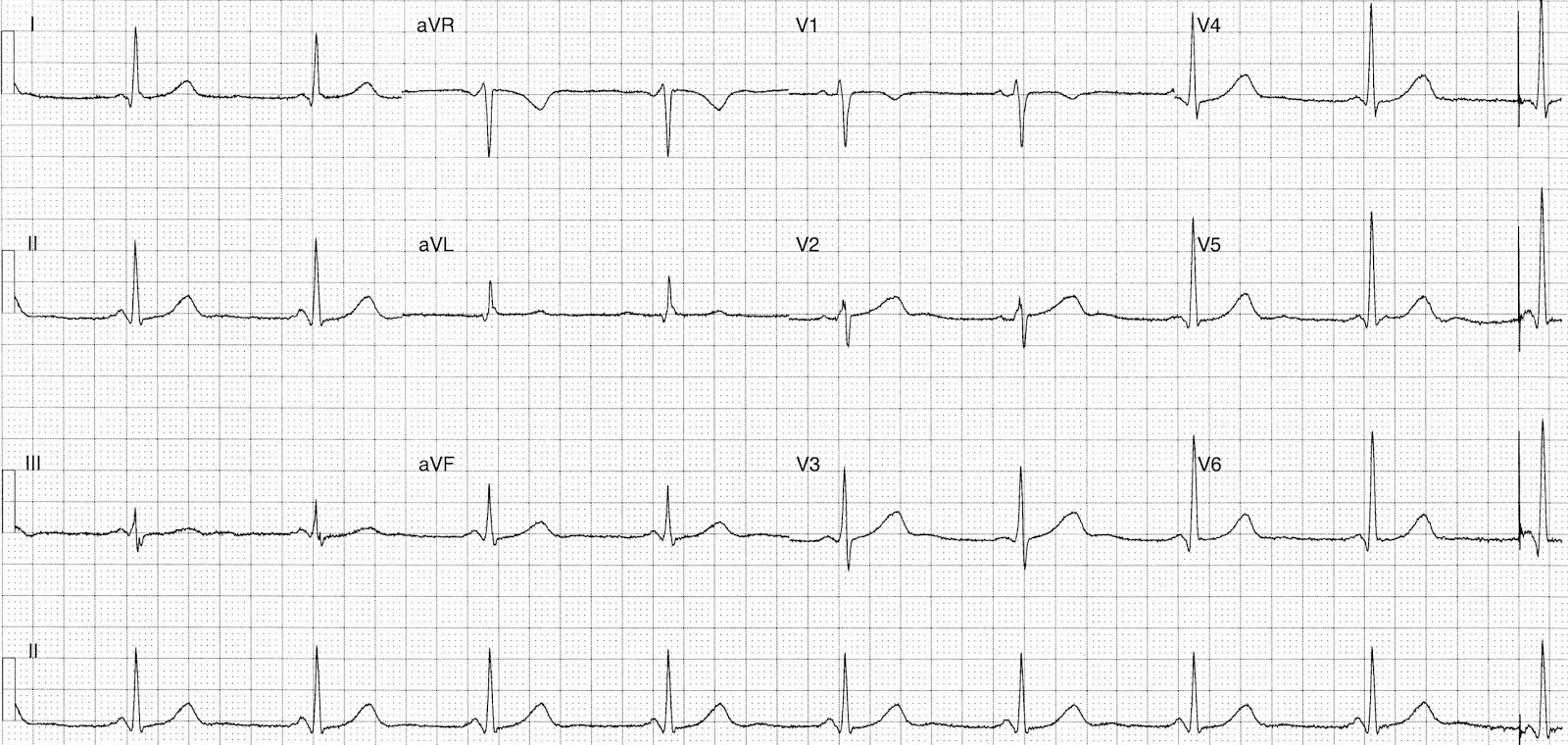 ECG of the Week: ECG of the Week - 9th November 2015