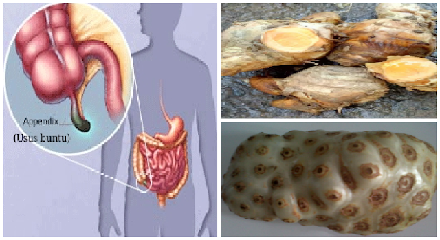 INILAH Obat Tradisional yang Terbukti Ampuh Untuk Mengobati Usus Buntu ...