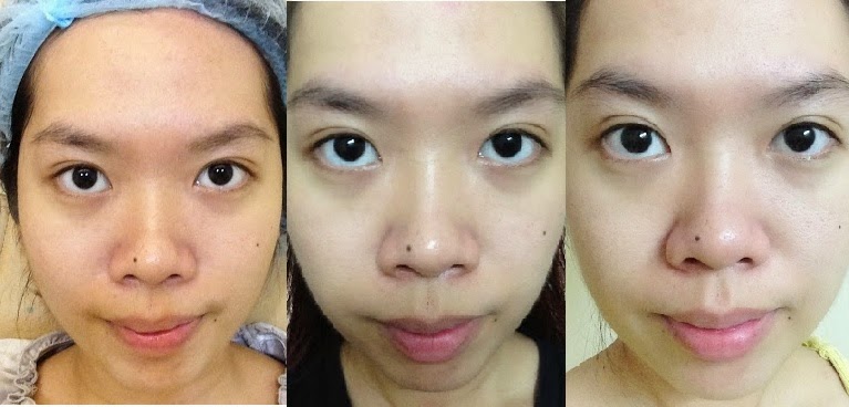 ~Dreamer~: Ido's Revlite facial laser treatment