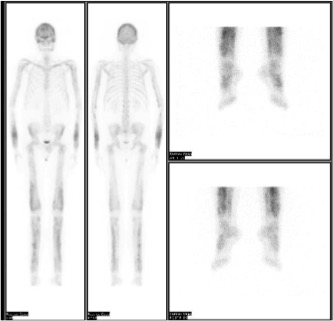 DIAGNOSTICO | Camurati Engelmann Spain