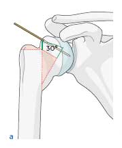 Shoulder and Elbow Surgery: Corrective osteotomy for surgical neck ...