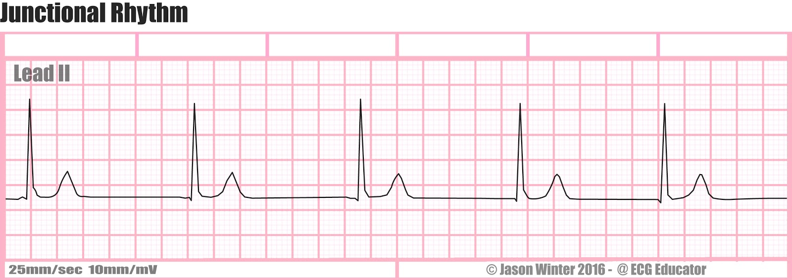 ECG Educator Blog : Six Second ECG Rhythm Strips