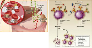 Medical Lecture Notes: Chronic Lymphocytic Leukemia - CLL Lecture Notes ...