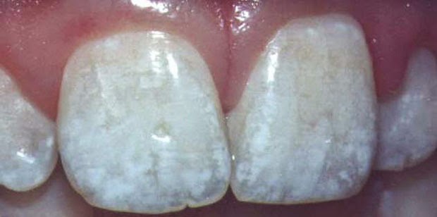 FLUOROSIS: FLUOROSIS DENTAL Y SUS CAUSAS