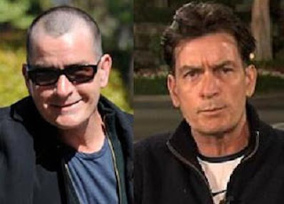 Neiman Dermatology and Hair Transplantation: Charlie Sheen Not "Winning ...