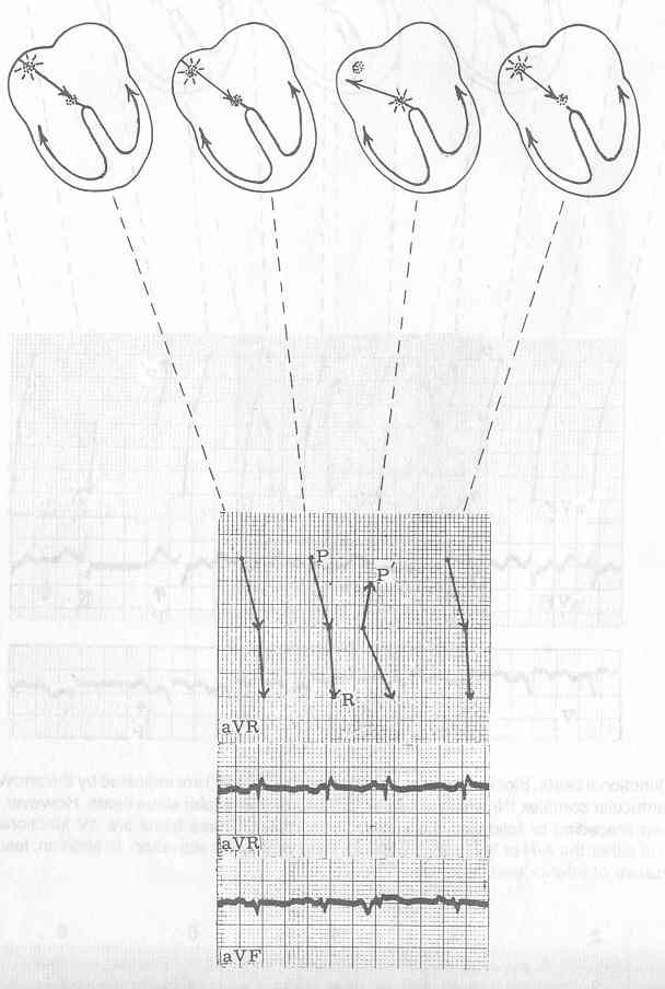 Pedi cardiology: Quiz, EKG: What is the rhythm? Junctional vs. Low ...