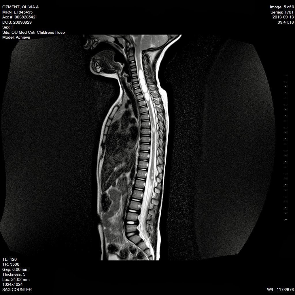 Children's Chiari Journal: Syringomyelia - A word I have learned to say ...