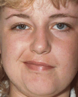 Home: Bell's palsy / bibir merot