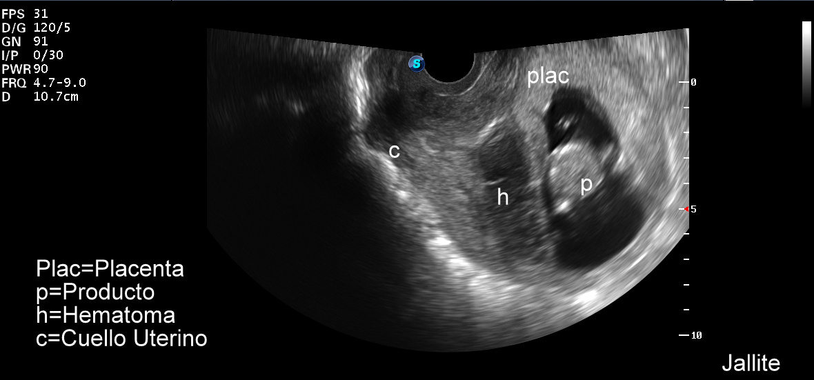 Hematoma Placentario