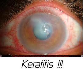 Flying Petals: Keratitis