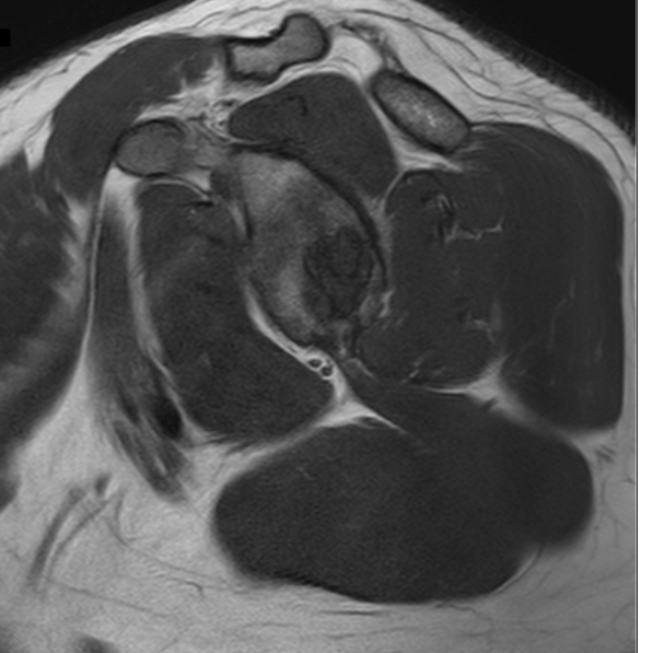 Glenoid Subchondral Cystic Lesion -Approach. - Sumer's Radiology Blog