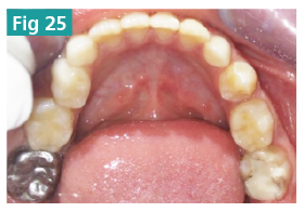 Molar Incisor Hypomineralization (MIH): Conservative Treatment Approach