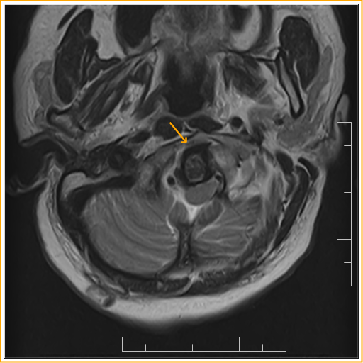 Basilar Invagination-MRI - Sumer's Radiology Blog