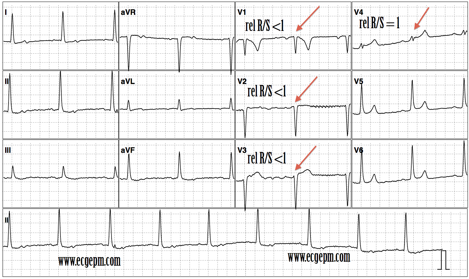 Bloqueio Divisional Anterosuperior Esquerdo - RETOEDU