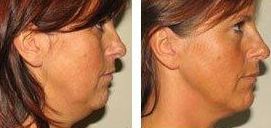 Facial Exercises Produce Wonderful Non-Surgical Facelifts : Face ...