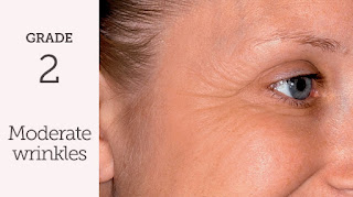 Dr Gerard Ee | Clifford: Crow's Feet - How To Get Rid Of Them?