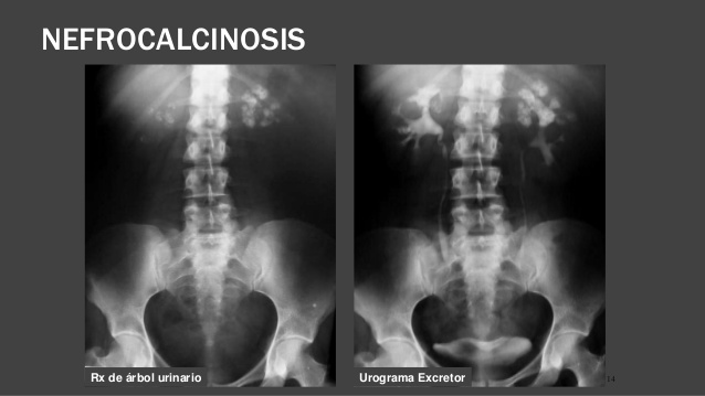 nefrocalcinosis