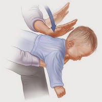Pertolongan Pertama Pada Bayi / Anak yang Tersedak