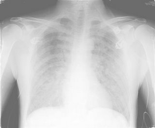 Treatment of acute respiratory distress syndrome (ARDS ...