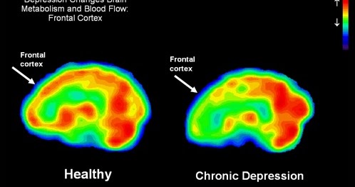 Let's TALK about Genoism: Normal Brain vs. Depression Brain