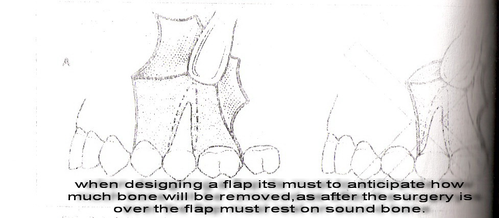 WizDent: Principles Of Complicated Exodontia-Surgical/Open method of ...
