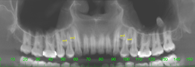 Ortodontia.com.Borel: Dentes Supranumerários.