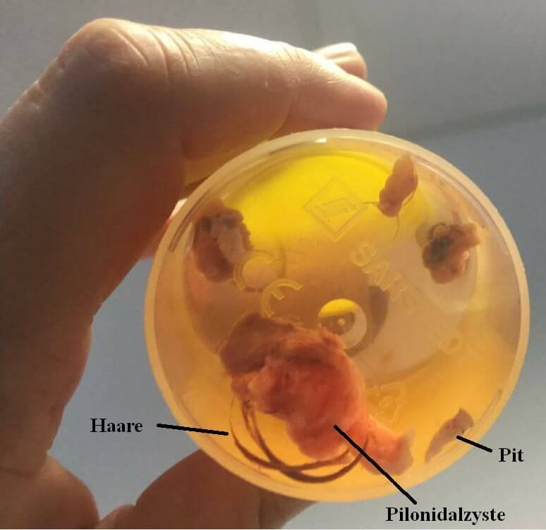 Pilonidal cyst on the butt: Procedure according to Moshe Gips