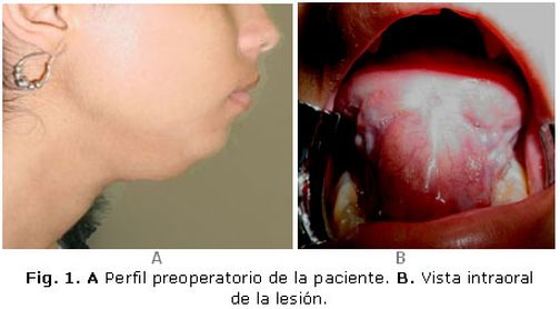 Quiste dermoide del suelo de la boca: Caso Clínico - Odontología Virtual