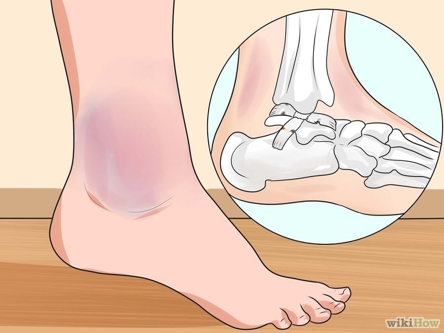 Terapia Física y Rehabilitación en Culiacan : Esguince