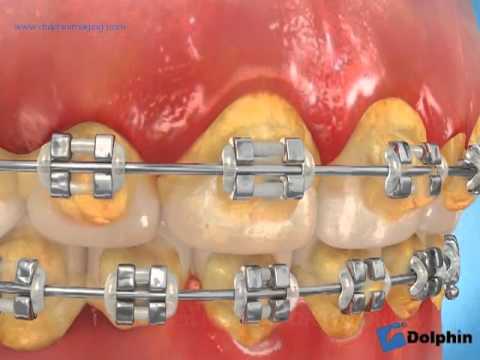 AUMENTO DE PLACA BACTERIANA RELACIONADA CON EL USO DE BRACKETS: MARCO ...