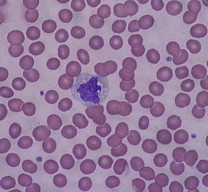 Fichero de Hematología: Anormalidades leucocitarias
