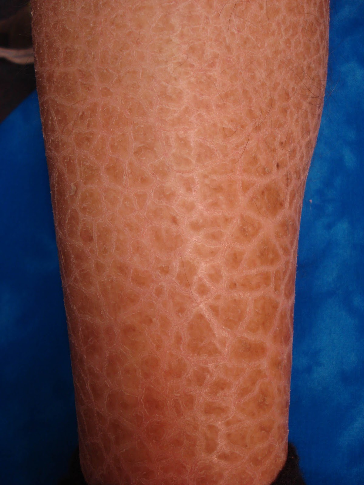 VIRTUAL GRAND ROUNDS IN DERMATOLOGY 2.0: Recessive X-Linked Ichthyosis