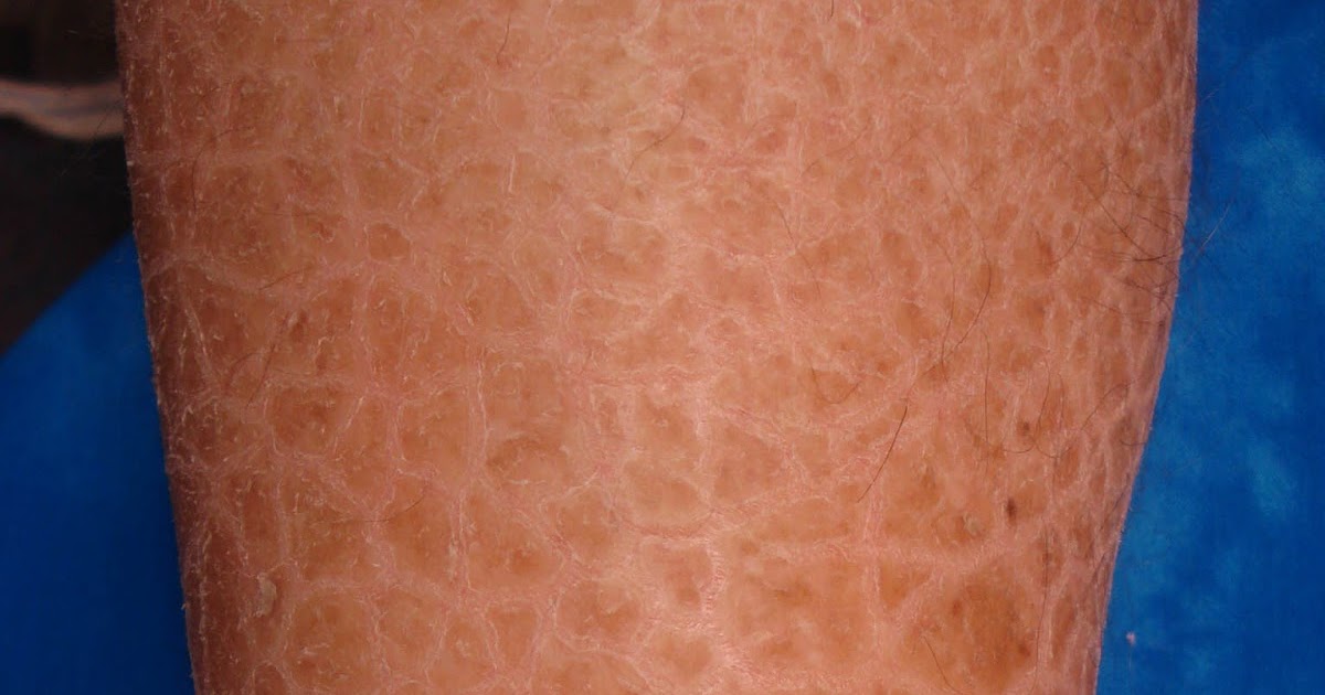 VIRTUAL GRAND ROUNDS IN DERMATOLOGY 2.0: Recessive X-Linked Ichthyosis