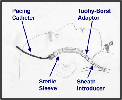 Dr. Smith's ECG Blog: Emergency Transvenous Cardiac Pacing