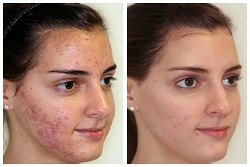 Microdermabrasion Before And After | plasticsurgerybeforeandafter