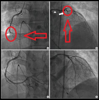 Serangan Jantung STEMI,....Datangnya Secara Mendadak dan menjadi ...