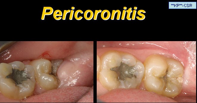 Best Dental Clinics - 9381070890: What is Pericoronitis