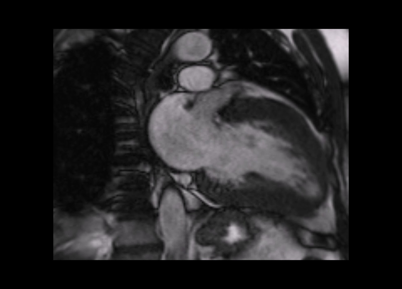Andrew R. Houghton: Understanding LVH: Concentric versus eccentric ...