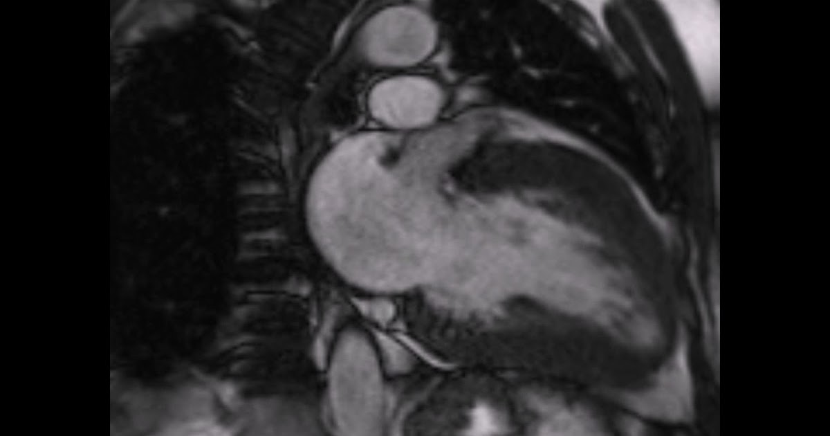 Andrew R. Houghton: Understanding LVH: Concentric versus eccentric ...