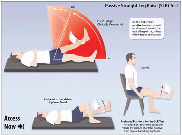 Reviews & Opinions in Emergency Medicine: Sciatica... The Pain That ...