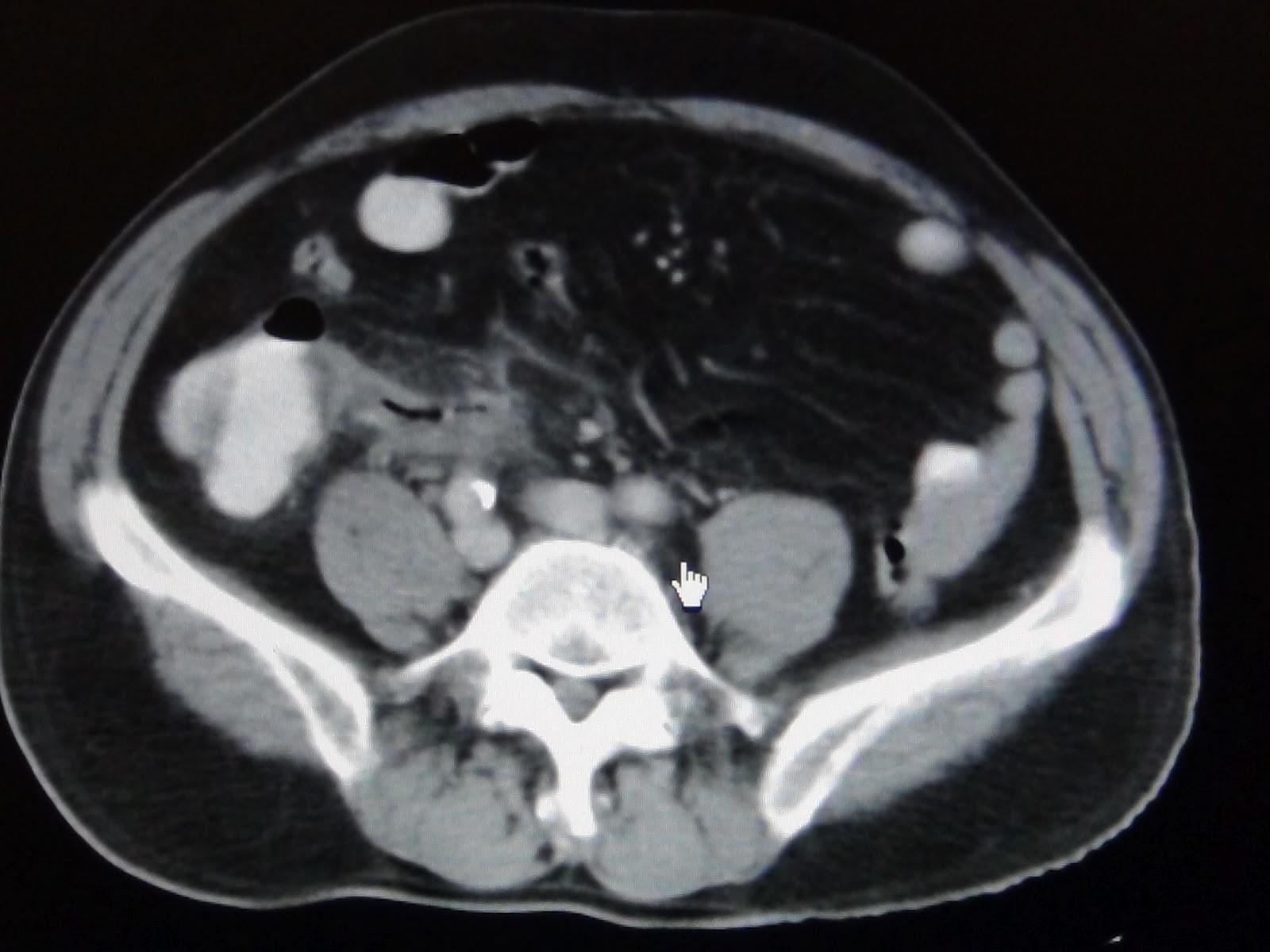 Endoscopia y Cirugía Digestiva: Apendicitis aguda perforada.
