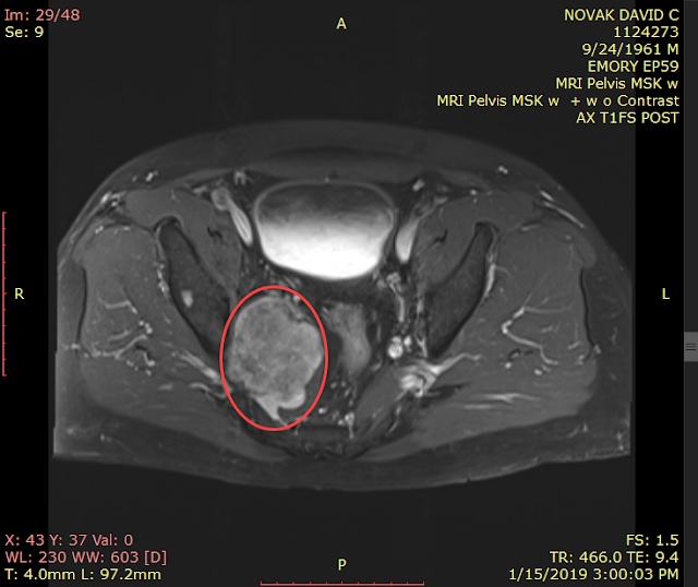 My Battle with Myxoid Liposarcoma: 10-Year Scan Results