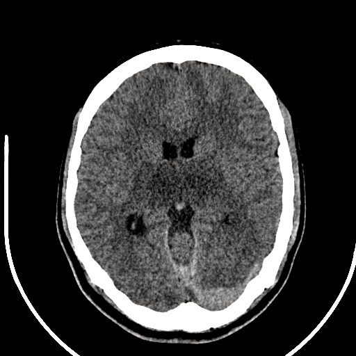 Ultimate Radiology : Bilateral thalamic and cerebellar hypodensity