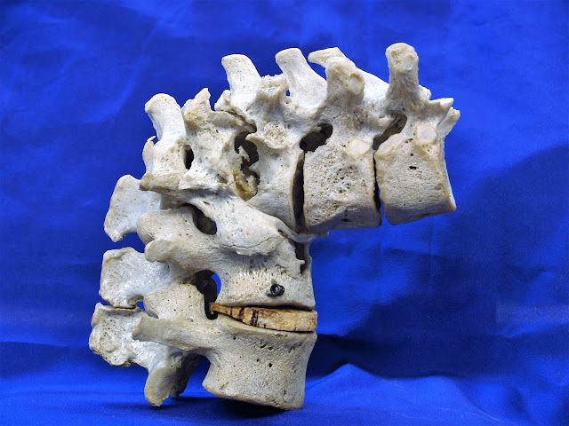 Fieggentrio: Zijn er nog mensen met een bochel?