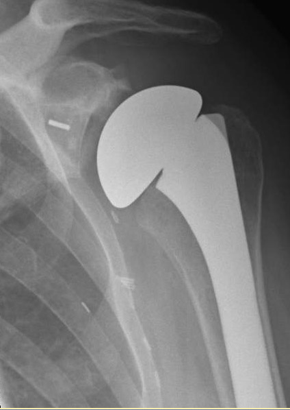 Shoulder Arthritis / Joint Replacement : Locked dislocation of a total ...