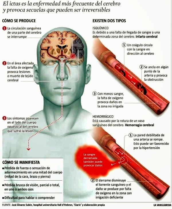 Accidente Cerebro Vascular Del Tipo IsquÉmico